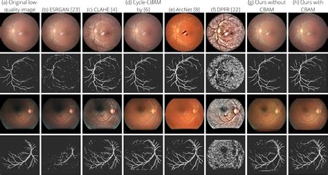 Figure 6 From Retinal Image Restoration And Vessel Segmentation Using Modified Cycle Cbam And