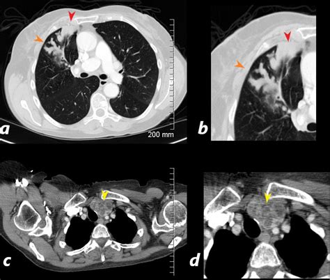 Faces Of Lymph Nodes Low Density Lungs