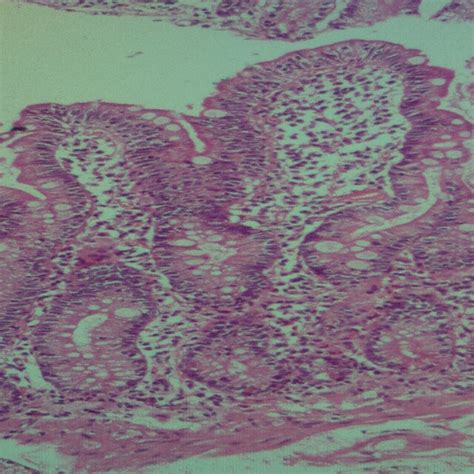 Endoscopic Biopsy From Duodenum Revealed Villi Shortening With