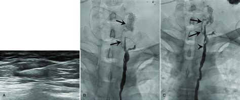 A Ultrasonographic Guided Inguinal Node Puncture For Lymphatic