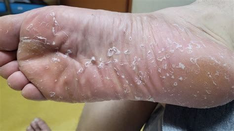 발바닥 무좀 지겹네요ㅠ 지식in