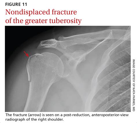 Step By Step Evaluation And Treatment Of Shoulder Dislocation Mdedge