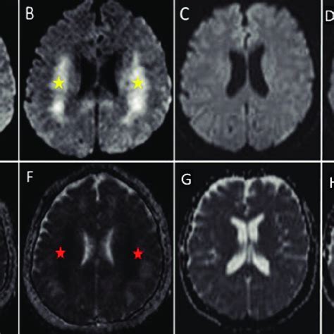Year Old Female Images A Acute Diffusion Restriction In The Middle Download Scientific