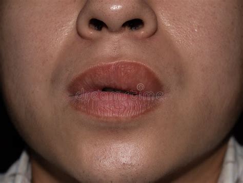 Bacterial Infection On Lips