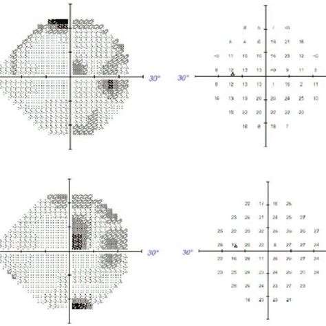 Humphrey Visual Field Examination A Before Vitrectomy The Mean