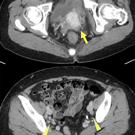 Ct Image Showing A Retrovesical Mass On The Left Posterior Wall Of The Download Scientific