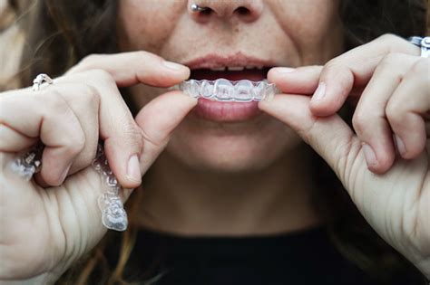 보이지 않는 치아 보호대를 착용하는 알아볼 수 없는 여성 미적 교정 미용 치의학에 대한 스톡 사진 및 기타 이미지 미용 치의학 건강관리와 의술 구별하기 힘든 Istock