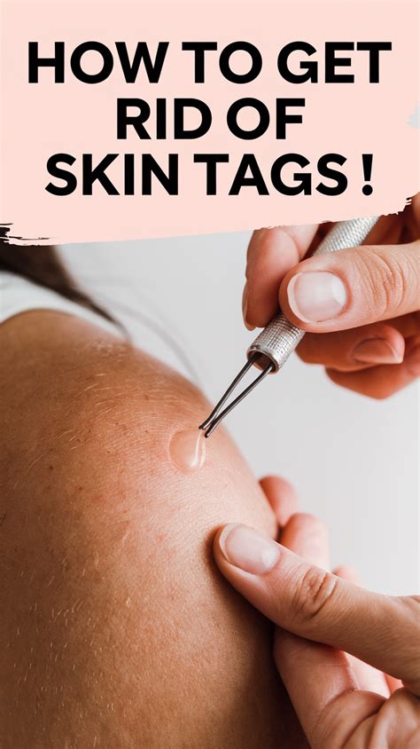 How To Remove Skin Tags Safely Expert Tips And Proven Methods