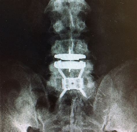Artificial Disc Replacement Spinal Disc Center Kris Radcliff Md