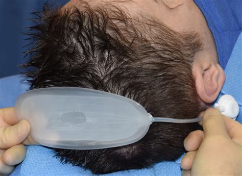 Scalp Tissue Expander For Skull Augmentation Dr Barry Eppley Indianapolis Explore Plastic Surgery