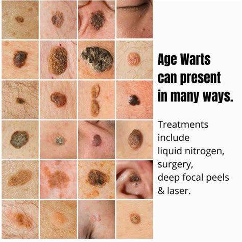 Age Wart Types Of Warts Warts Facial Warts