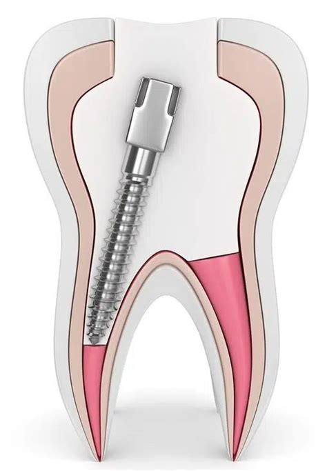 Reconstructie Dinte Masea Cu Pivot Etape Pret Pivot Dentar Si Coroana