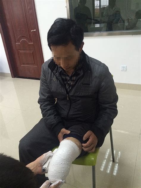 小腿假肢取型记录照片 长沙佳满