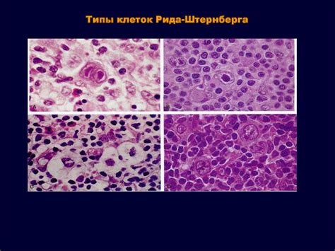 Опухоли системы крови и лимфоидной ткани Online Presentation