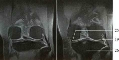 膝关节MRI解剖 骨骼肌肉影像图谱 医学