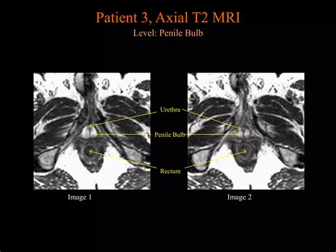 Prostate Mri Anatomy From University Of Michigan Pptx