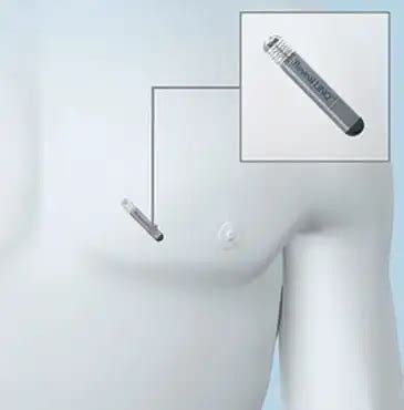 Implantable Loop Recorder In Houston Tx Electrophysiologist In