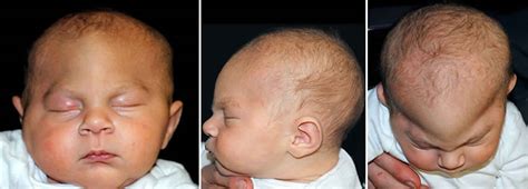 Craniosynostosis Causes Symptoms Treatment And Craniosynostosis Surgery