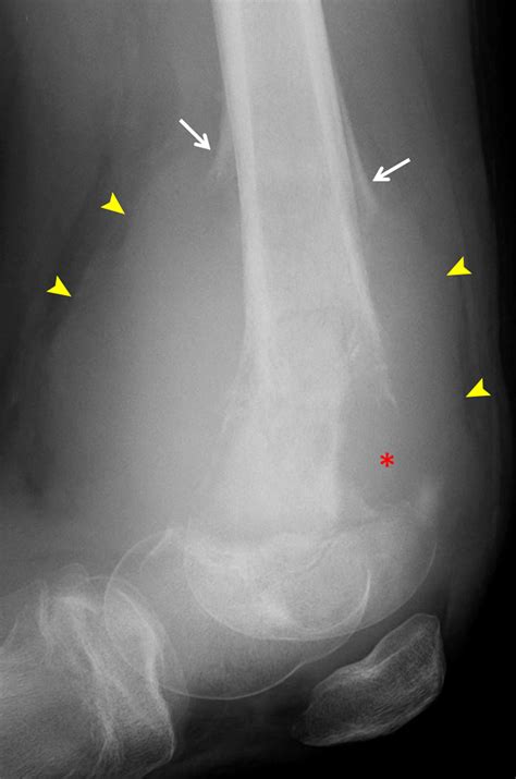 Radiographic Evaluation Of Bone Tumors Radiographics Radiographic Evaluation Of Bone Tumors Radiographics
