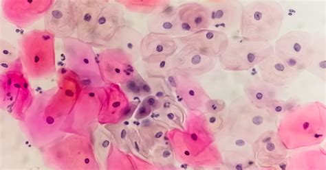 Hpv Related Cervical Cancer Rising In Some Women New Research Finds