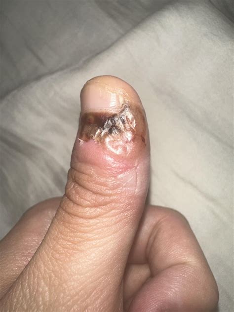 Dark Scab Forming After Draining Abscess From Severe Paronychia R Medical