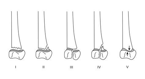 Fractures Overview