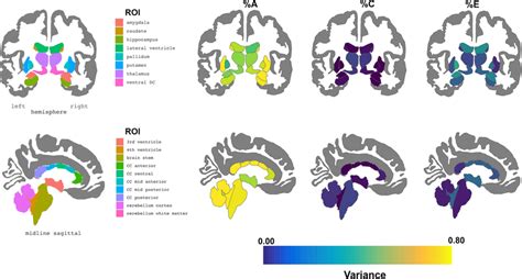 Genetic Influences On Subcortical Callosal Ventricular And Posterior