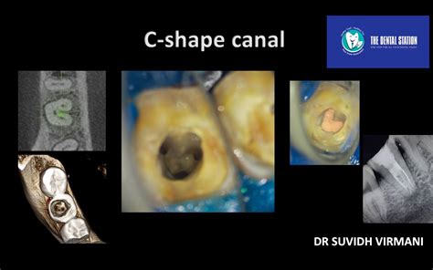 C Shape Canals Are Commonly Seen In The Dental Station