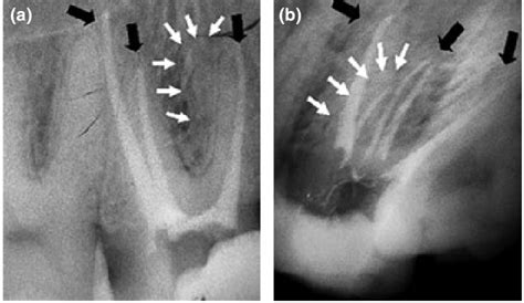 A A Maxillary First Molar With An Accessory Root White Arrows Which Download Scientific