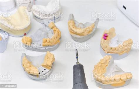 치과 주조 석고 모델 석고 캐스팅 치과 인간의 턱 Prothetic 실험실 기술 샷 3차원 형태에 대한 스톡 사진 및 기타 이미지 3차원 형태 치과 장비 치아 건강