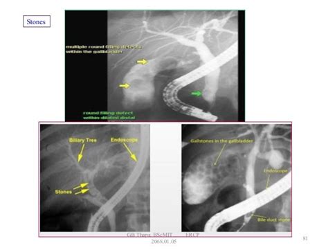 Ercp Procedure Ercp Procedure