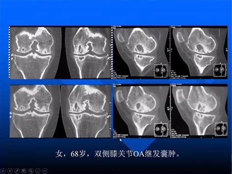 专家视角关节周围囊状骨破坏的诊断与鉴别 田军教授 文章管理后台