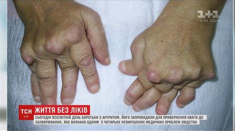Хворі на ревматоїдний поліартрит втратили шанс на лікування коштом ...