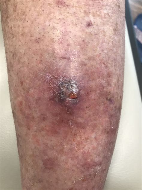 Pyoderma Gangrenosum With Systemic Symptoms Initially Misdiagnosed As