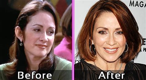 Patricia Heaton Plastic Surgery Photos