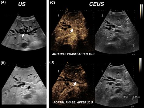 Cholangiocarcinoma Ultrasound