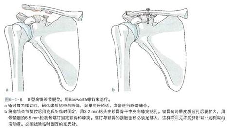 锁骨骨折的治疗原则 知乎