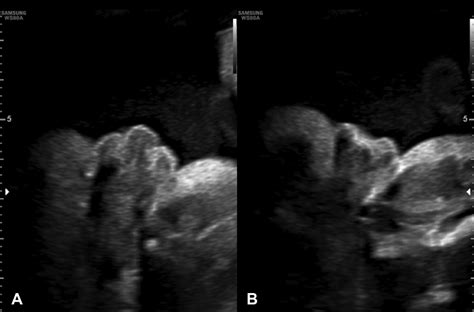 Ambiguous Genitalia Ultrasound Ambiguous Genitalia Ultrasound