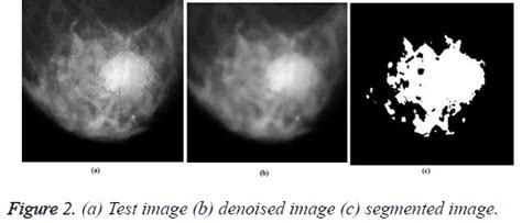 An Improved Cad System For Abnormal Mammogram Image Classification