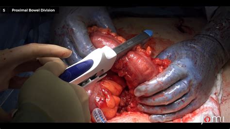 Laparoscopic Low Anterior Resection With Diverting Loop Ileostomy For Rectal Cancer With