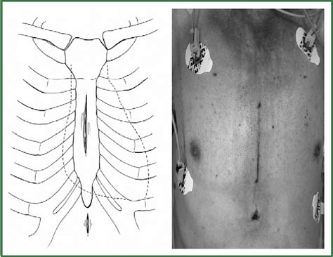Figure 1 From Minimal Access Median Sternotomy For Aortic Valve Replacement Semantic Scholar