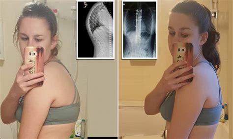 Kyphosis Treatment Ways To Alleviate Pain And Improve Posture