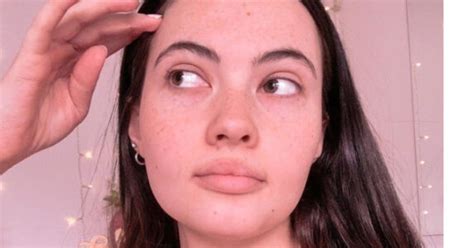 물만 닿아도 뒤집어져항상 피부 빨간 美여성 사연 뭐길래