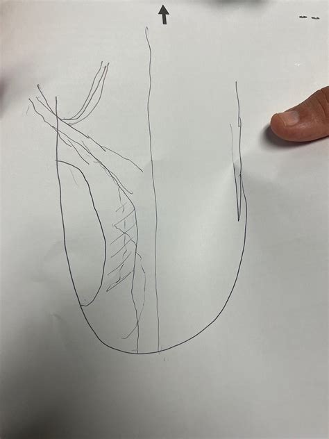 So Youre Having A Partial Glossectomy By Scott Gordon Sep 2024 Medium