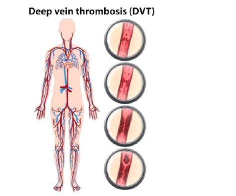 Deep Vein Thrombosis All You Need To Know Sancheti Hospital