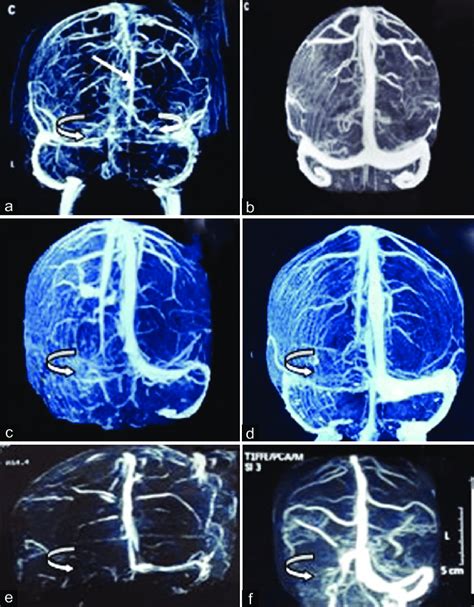 A Ct Venogram Superior Sagittal Sinus Thrombosis Straight Arrow With Download Scientific