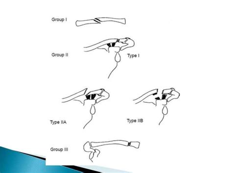 Dr Naveed Clavicle Fracture Classification Pptx