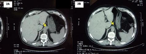 Computed Tomography Scan Showing An Interaortocaval Lymph Node Download Scientific Diagram