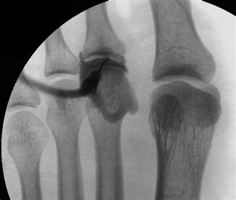 Mr Arthrography Of The Second And Third Metatarsophalangeal Joints For