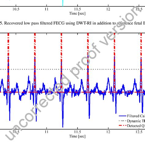 automatic detection of the fetal qrs complex qrs complex is